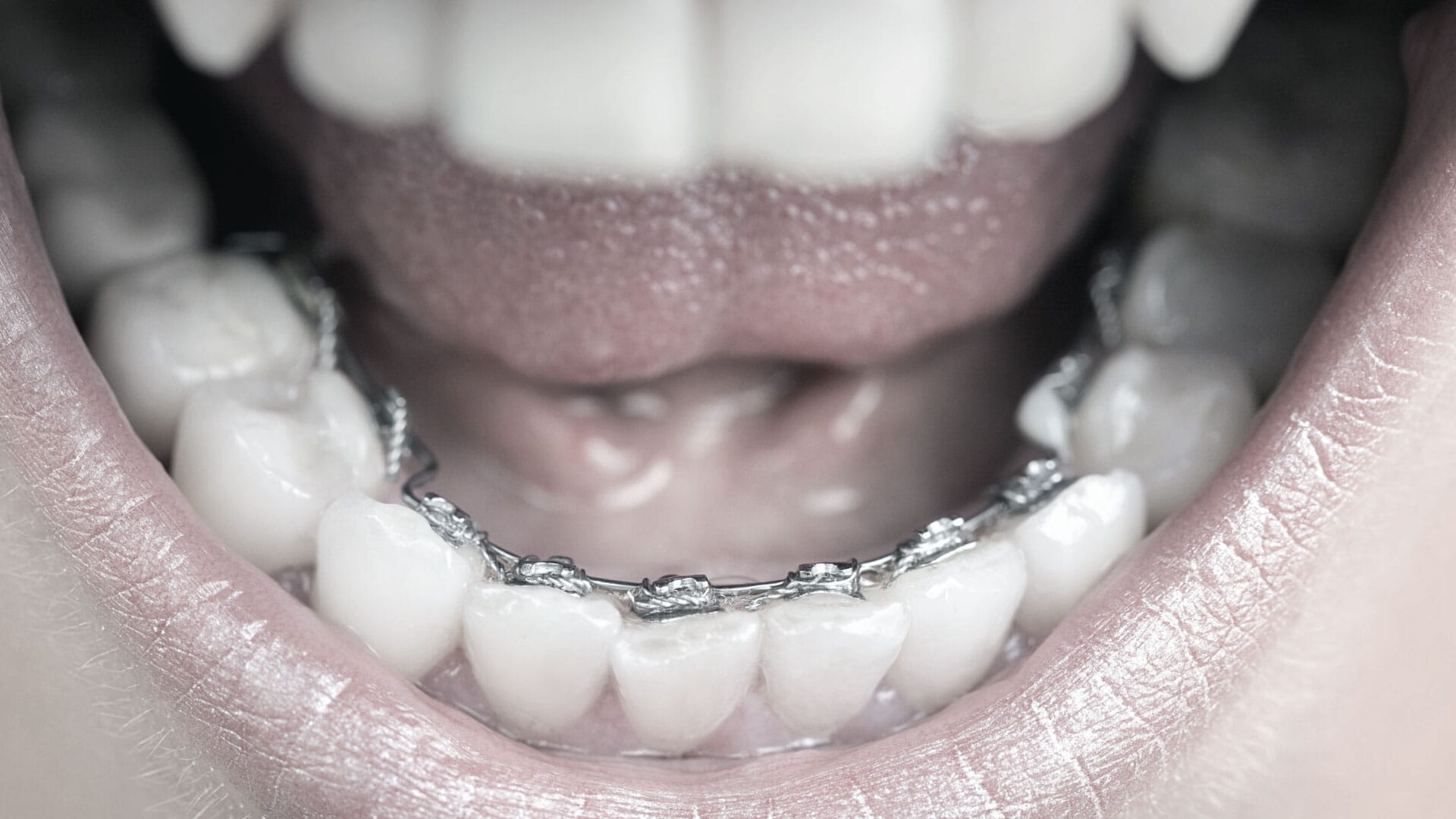 Ortodonti (Diş Teli & Şeffaf Plaklar) | DENTMODEL - Her Gülüşte Birlikte