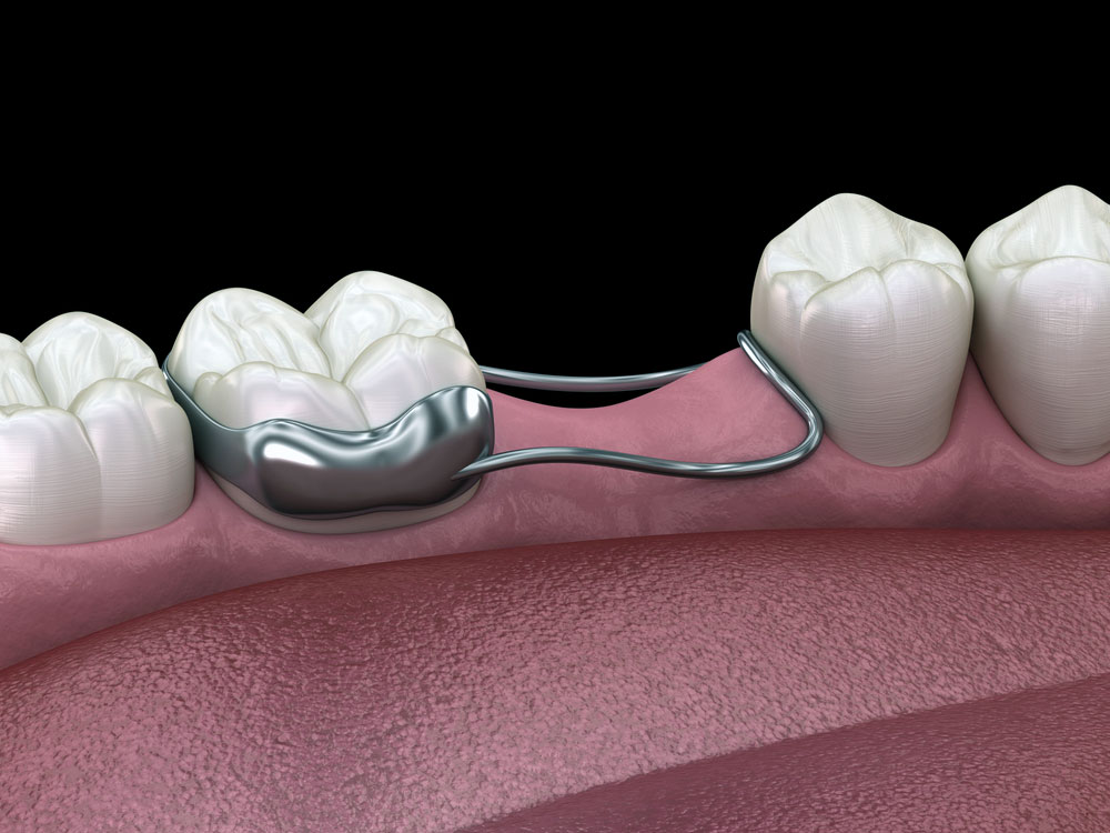 Yer Tutucular | DENTMODEL - Her Gülüşte Birlikte